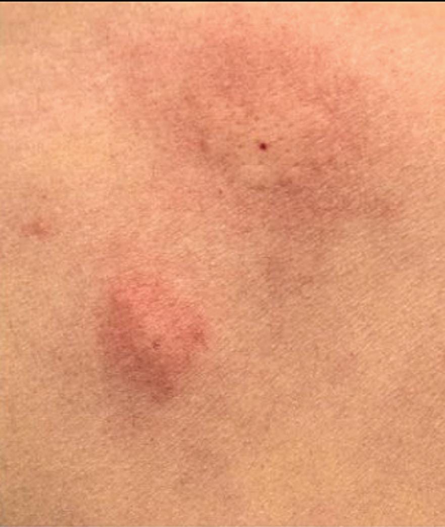 Flea Bites vs Mosquito Bites - What's the Difference? | Manhattan ...